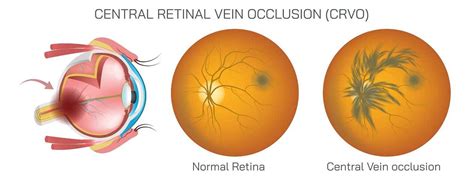 Understanding Oct Retinal Scan A Comprehensive Guide