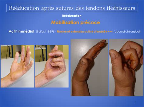 Rééducation après lésion tendons fléchisseurs des doigts Denis GERLAC