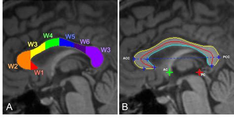Automatically Defined Boundaries Of The Corpus Callosum A