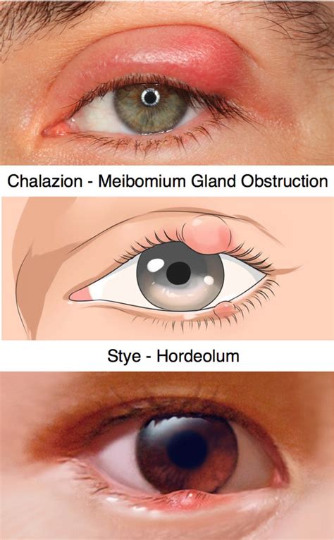 Chalazion In The Lower Eyelid Stock Image C0166853 Sc