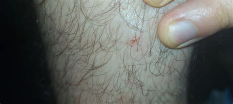Bug Bite Swollen Ankle R Diagnoseme