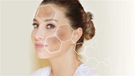 Melasma Treatment Effective Solutions For Brighter Skin Dr Cindys