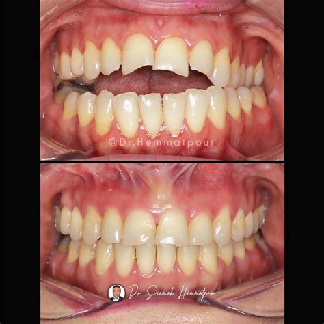 ‎متخصص ارتودنسی‎ ‎ ♦️ درمان یک مورد بیمار کلاس ۳ بدون جراحی و کشیدن