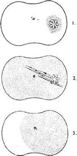 Migraine And Other Headaches Ento Key