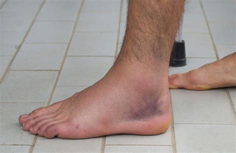 Attenzione A Questo Sintomo Controlla Se Hai Questo Segno Sulle Caviglie