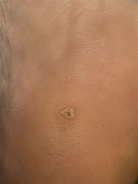 Foot Plantar Wart Or Blister Rmedicaladvice