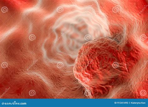Esophageal Cancer Stages Cartoon Vector CartoonDealer 227607487
