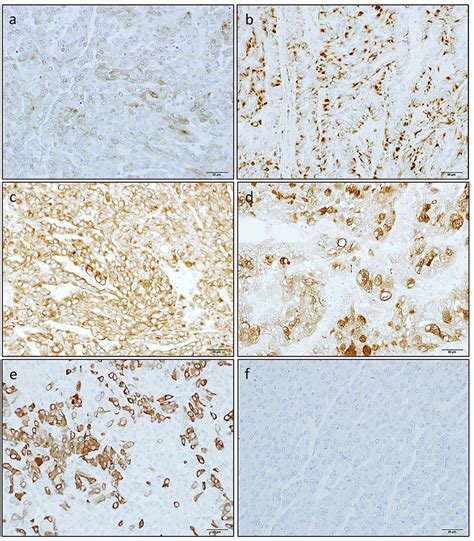 Immunohistochemical Staining Of The Primary Lesion The Cells Were