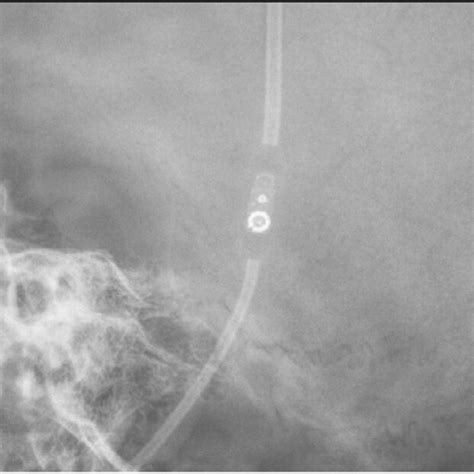 Lateral Skull X Ray Demonstrating A Right Frontal Approach Download Scientific Diagram