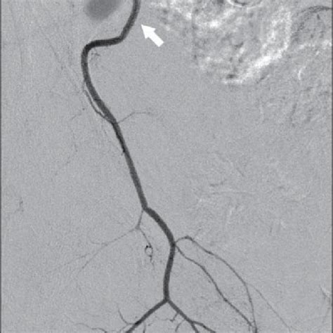 Digital Subtraction Angiography Demonstrates A 3 Mm Occlusion Balloon