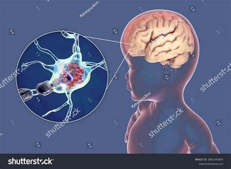 Taysachs Disease Lysosomal Storage Genetic Disorder Stock Illustration