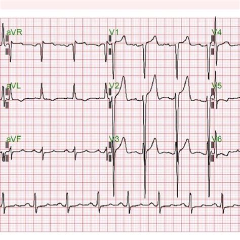 Electrocardiogram Showed Sinus Rhythm And Left Ventricular Hypertrophy