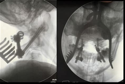 Intraoperative Fluoroscopy Showing A Type Ii Odontoid Fracture The