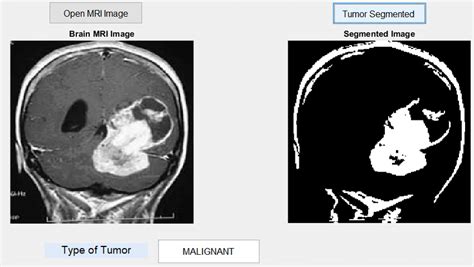 Detect That The Mri Image Has Malignant Tumor Download Scientific Diagram