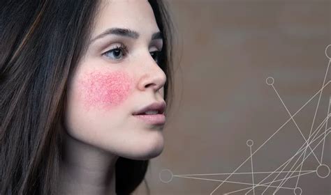 Amplifying Lupus Disease Activity With Real World Data And Machine