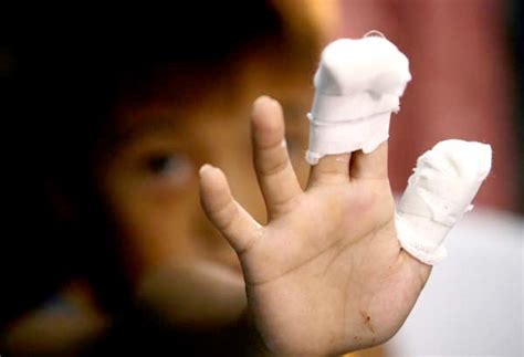 Nasugatan Kamay Ng Bata