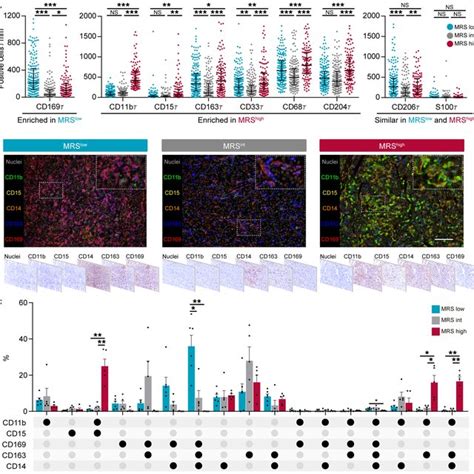 Mrs Reflects Different Myeloid Immune Contextures Between Hcc Tumors