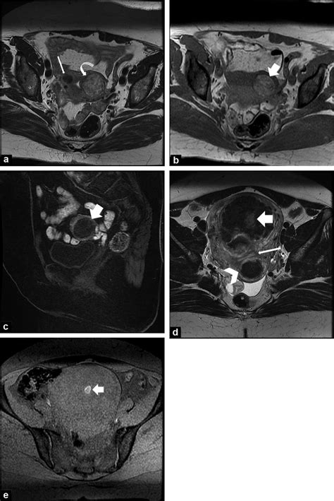 Role Of T1 Weighted Precontrast Sequences In Differentiating The