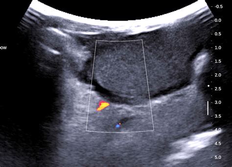 Vietnamese Medic Ultrasound Case 467 Submandibular Mass Dr PhẠm ThỊ