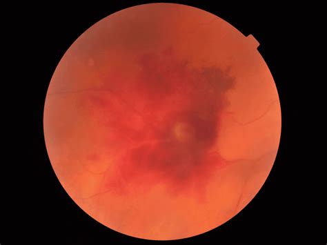 Past Issues The Journal Of Medical Optometry Jomo