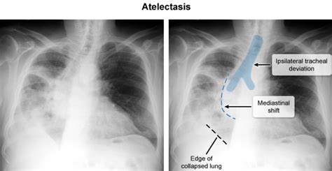 Atelectasis Vs Tension Pneumothorax Uworld Photos Rstep2