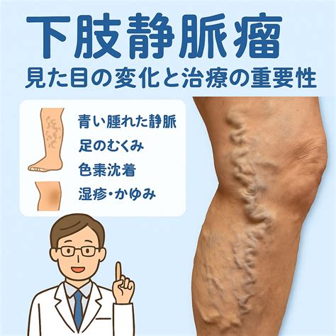 下肢静脈瘤の原因・症状・最新治療法を専門医が徹底解説 下肢静脈瘤の原因・症状・治療方法・予防方法などを専門医が解説