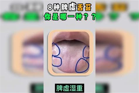 解析：8种脾虚舌象，看看你是哪一个？