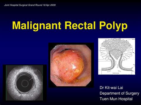 ppt malignant rectal polyp powerpoint presentation id 432580