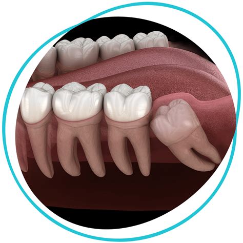 Wisdom Teeth Removal Morristown Nj And Flushing Ny