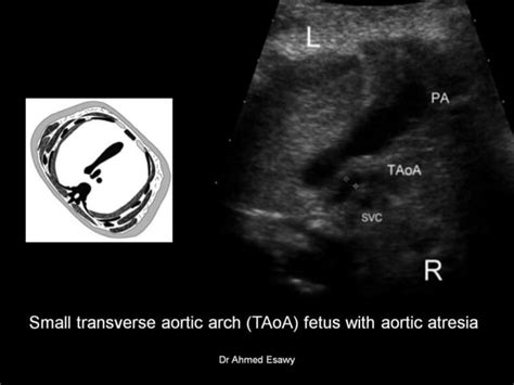 Fetal Echo Three Vessel Trachea View 3 Vt Dr Ahmed Esawy