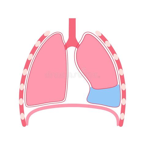 Pleural Effusion Poster Stock Vector Illustration Of Chest 274594348