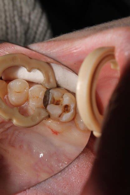 Premium Photo Caries Teeth Dentist