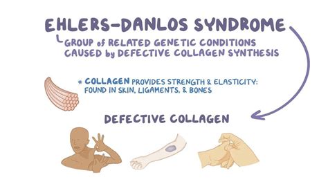Ehlers Danlos Syndrome Or Marfan Syndrome Quotes Welc