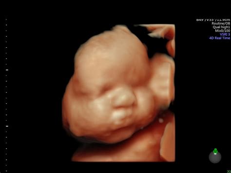 What Is Gestational Diabetes Lets Look At Symptoms Causes And