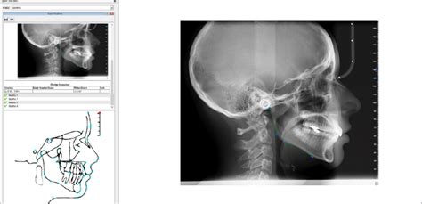 Gonial Angle Measurement On A Digital Lateral Cephalogram Download