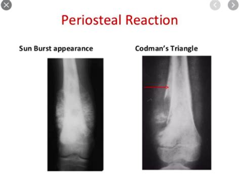 Osteosarcoma Codmans Triangle