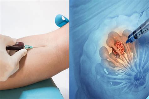 Liquid Biopsy Versus Traditional Tissue Biopsy Integrative Cancer Care