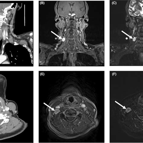 Hematoxylin And Eosin Hande Histopathology Of Neck Mass Hypercellular