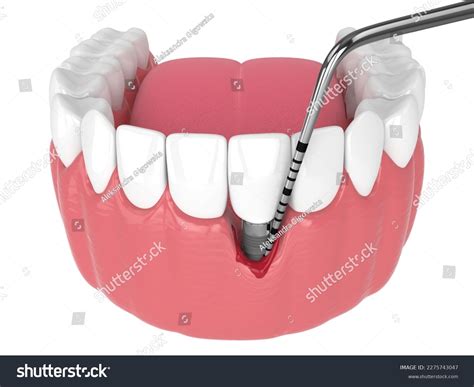 3d Render Human Jaw Peri Implantitis Stock Illustration 2275743047