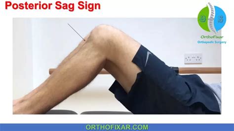 Posterior Sag Sign Orthofixar 2025