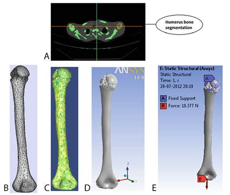 The Procedure Starts By Masking The Humerus Bone A Followed With