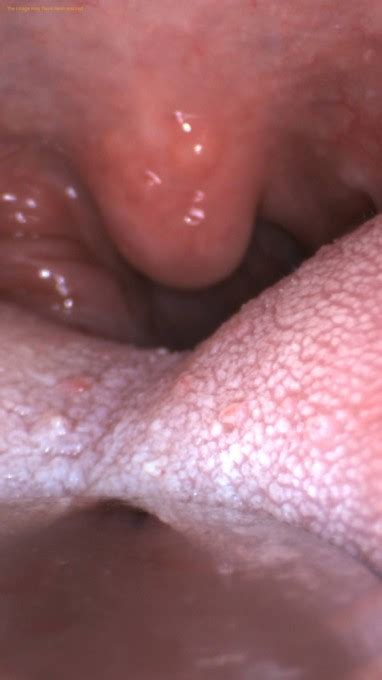 Bumps Ar Uvula Dental Update Orofacial Viral Infections An