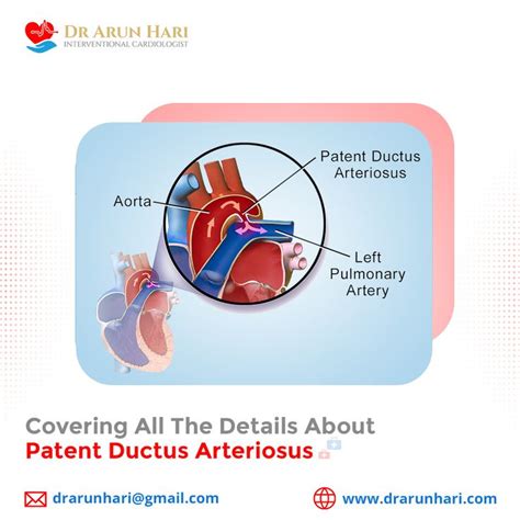 Covering All The Details About Patent Ductus Arteriosus Ductus Arteriosus Patent Ductus