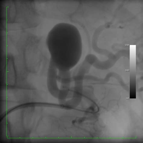 Embolisation Sydney Medical Interventions