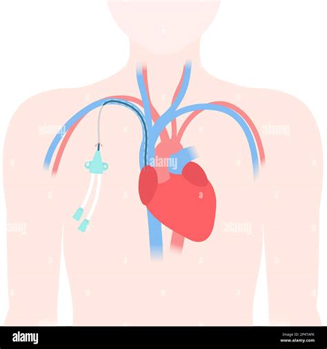 Non Tunneled Central Venous Catheter