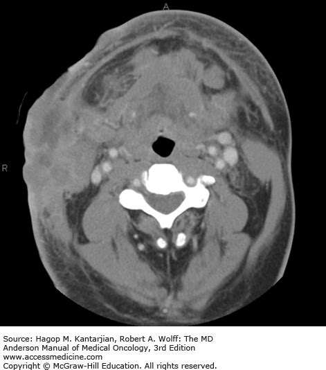 Aggressive B Cell Lymphomas Oncohema Key