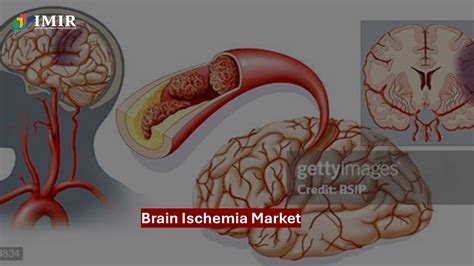 Brain Ischemia Advancing Stroke Prevention And Treatment Technologies
