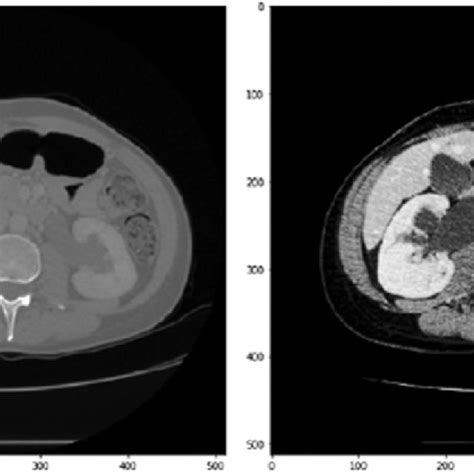 Pdf Liver Tumor Detection Using Cnn Resunet