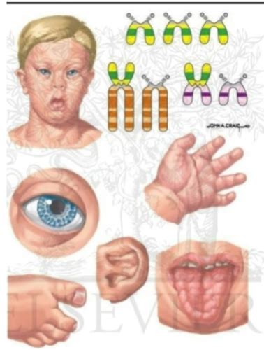 Peds Midterm Down Syndromegenetic Disorder Flashcards Quizlet