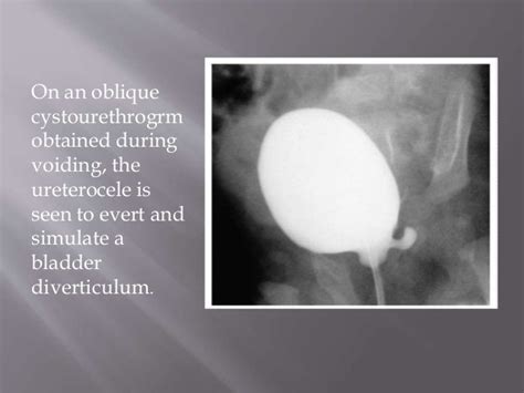 mcu micturating cysto urethrogram